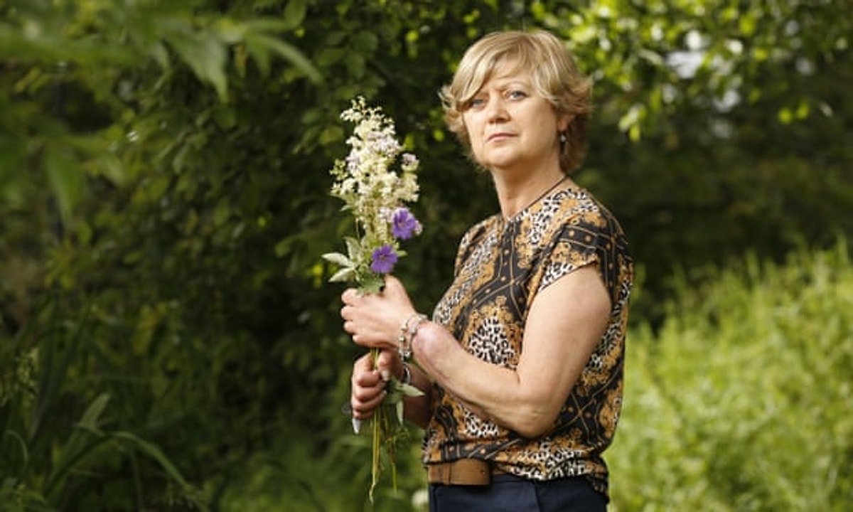 Uzuvlarını Kaybettikten Sonra İki Eli İçin de Donör Bulan Corrine ...