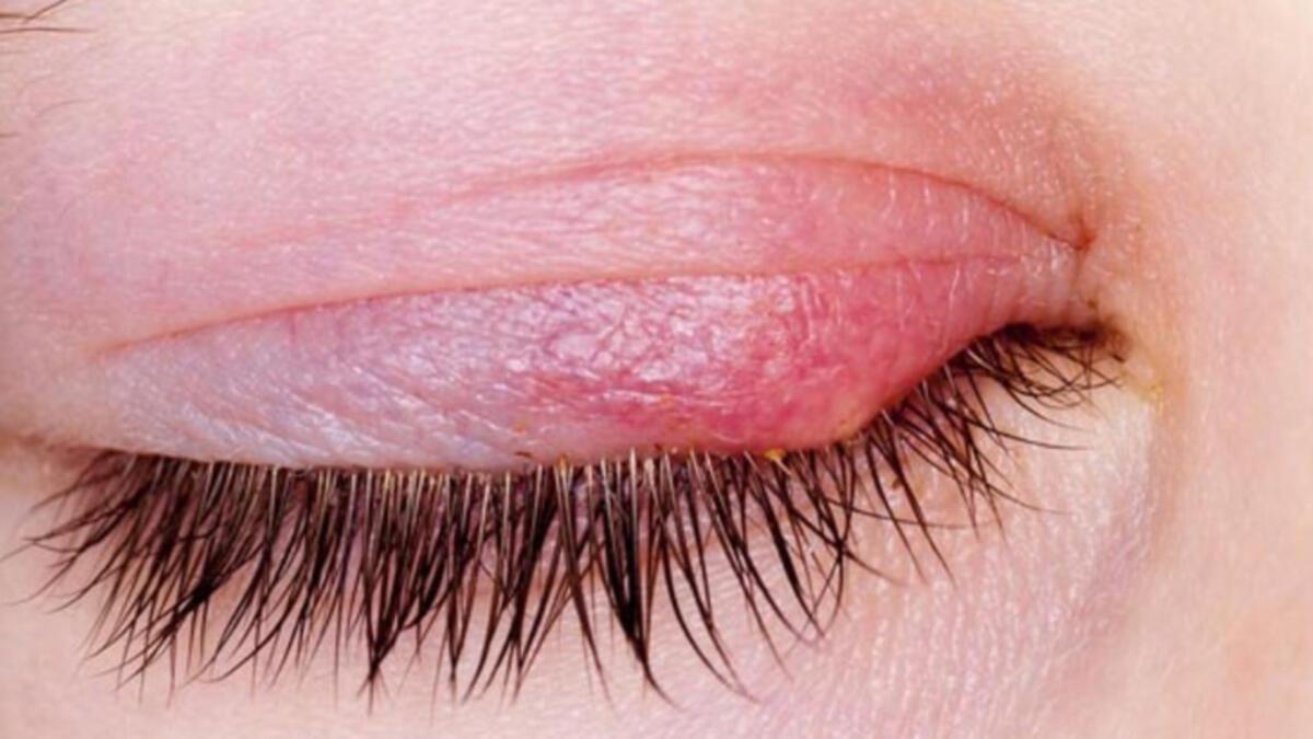 Arpacık Nedir, Belirtileri Nelerdir? Arpacık Tedavisi Nasıl Yapılır ...