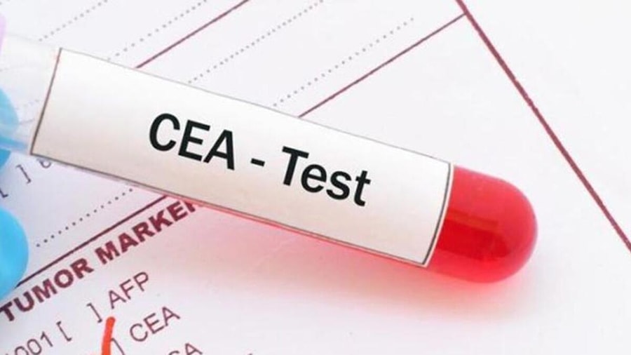 CEA Nedir? Yüksekliği ve Düşüklüğü Ne Anlama Gelir? Değerleri Kaç ...